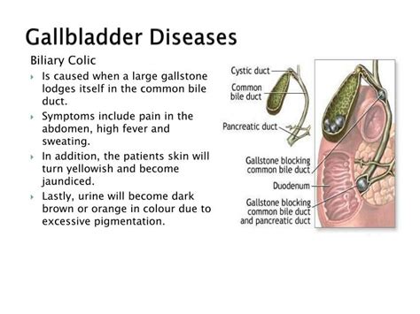 Gallbladder Disease Overview Types And Diagnosis Rvpz