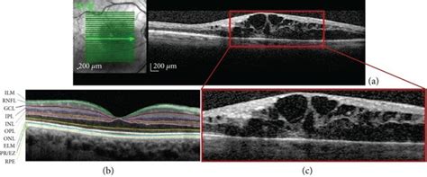 Oct Aspect Of Macular Dril A Disorganization Of The Inner Retinal Download Scientific