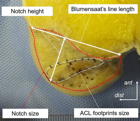 Measurement Of The Lateral Wall Of The Femoral Intercondylar Notch