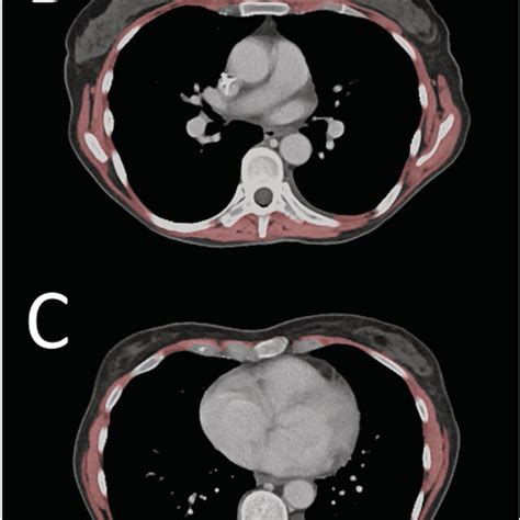 Illustration Skeletal Muscle Segmentation Red At The Level Of The Download Scientific Diagram