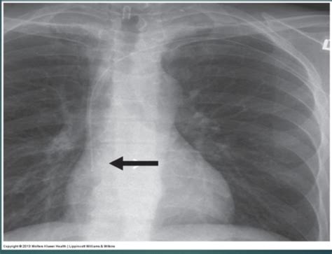 Ch 22 Central Vascular Access Device Placement Flashcards Quizlet
