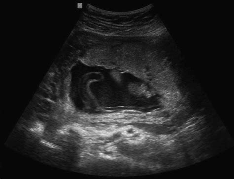 Cord Insertion Ultrasound At Genevieve Tarrant Blog