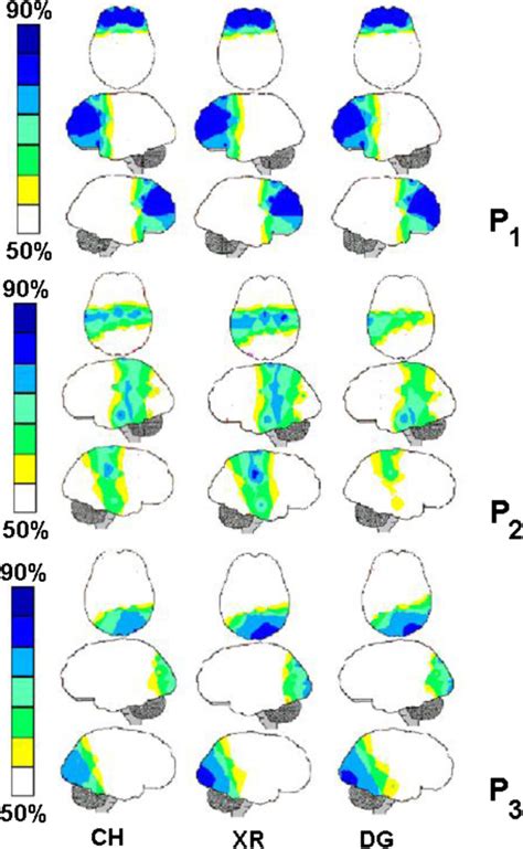Pca Brain Mappings P1 P2 P3 Associated With Clinical History