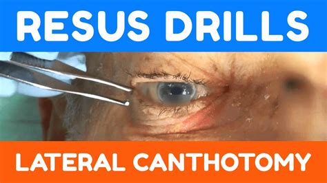 Resus Drills Lateral Canthotomy — Em3