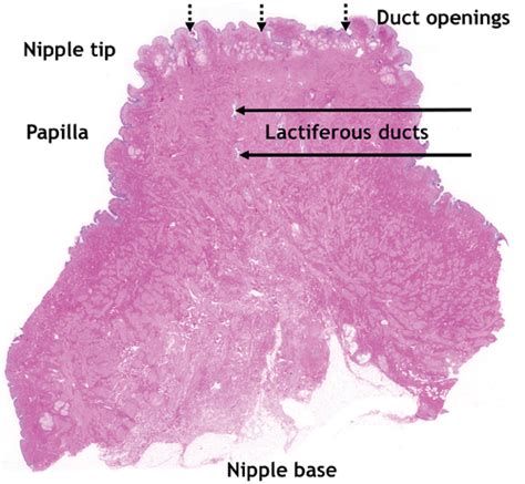 An Analysis Of Nipple Enhancement At Breast Mri With Radiologic