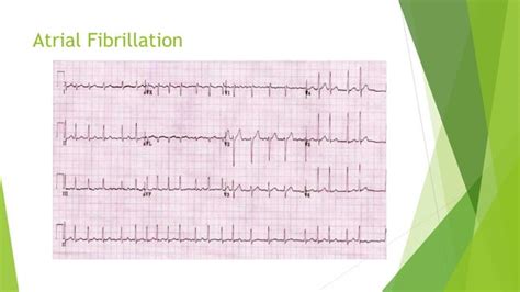 Tachyarrythmias In Clinical Practice Things To Know Ppt
