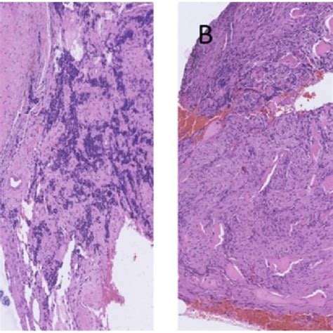 Ewing Sarcoma A And Osteomyelitis B In The Light Microscopy