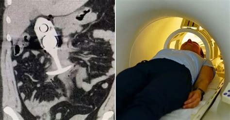 horror mri accidents from crushed nurse to sex toy dragged through
