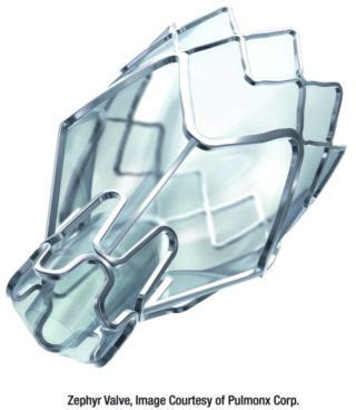 The Zephyr Valve Procedure Pinehurst Medical Clinic