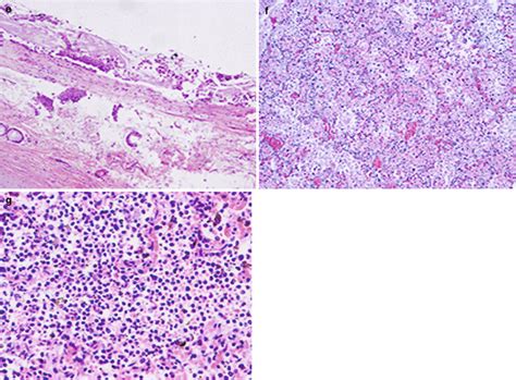 Measles Radiology Key