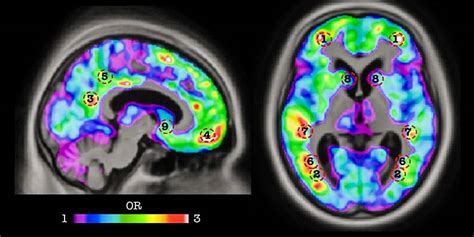 New Algorithm Can Detect Early Signs Of Dementia Years Ahead Of