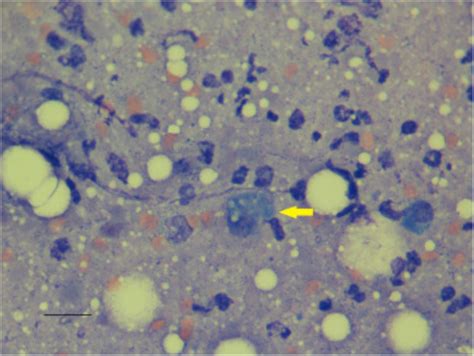 Microscopic Image Of Lymph Node Aspirate Arrow Macrophage Containing
