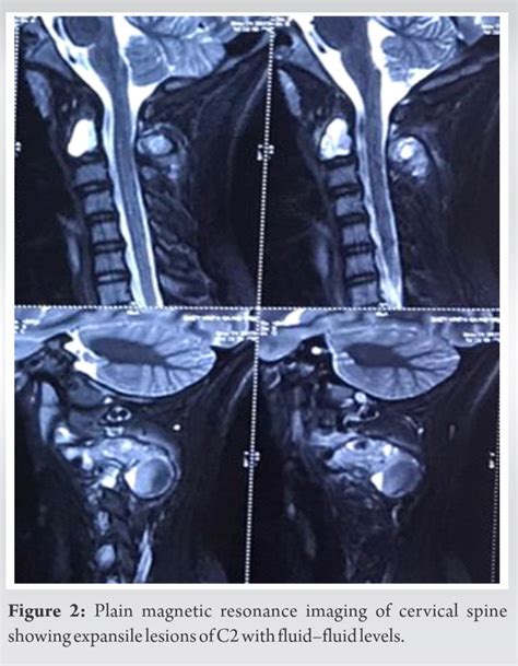 Back Bone Cyst At Ernest Rue Blog