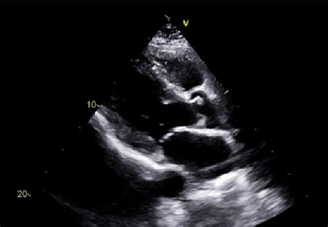 Figure 1 From Incidentally Discovered Endocarditis Leading To The