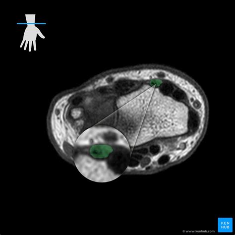 Extensor Compartment Radiology At Phoebe Bateman Blog