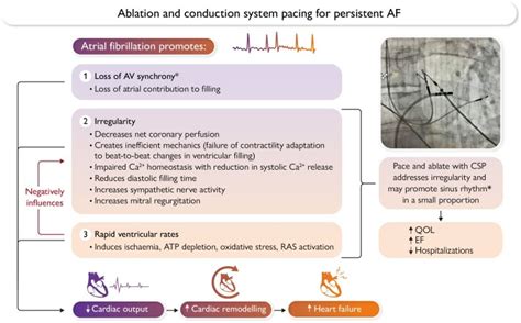 Atrioventricular Node Ablation For Atrial Fibrillation In The Era Of
