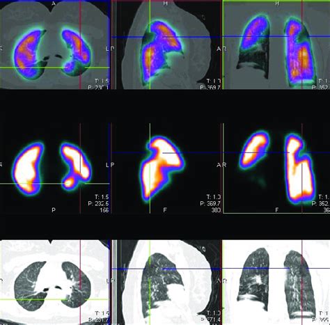 Perfusion Single Photon Emission Computed Tomographycomputed