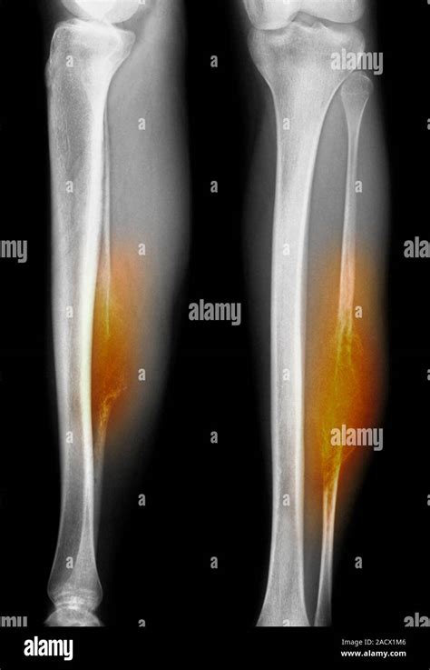 Ewing Sarcoma X Ray
