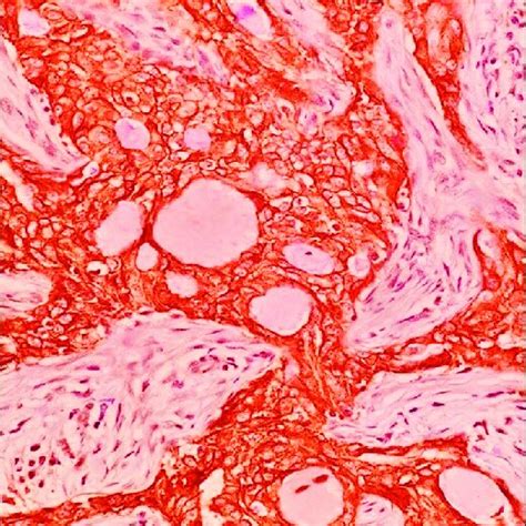 High Expression Claudin 4 In Tumoral Cells Original Magnification×40