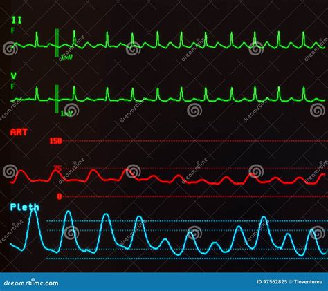 Atrial Flutter With Variable Conduction Royalty Free Stock Photography CartoonDealer Com