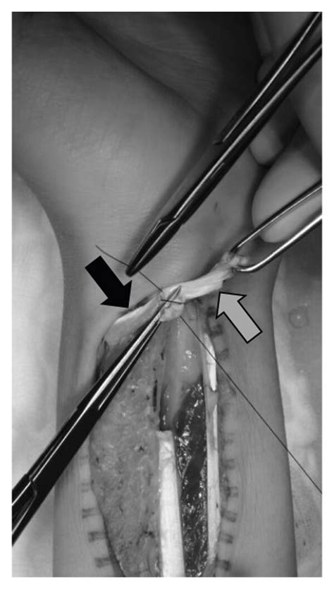 A 23 Year Old Female With A Synovial Sarcoma On The Left Elbow Joint