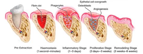 Tooth Extraction Healing Implantation Part 1