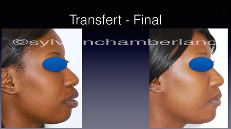 Ethnicity And Premolar Extraction Dr Sylvain Chamberland Orthodontist