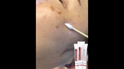 반점 제거 연고 Youtube