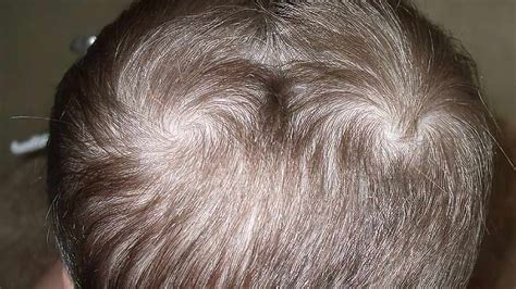 Causes Of Double Crown Hair And Its Myths