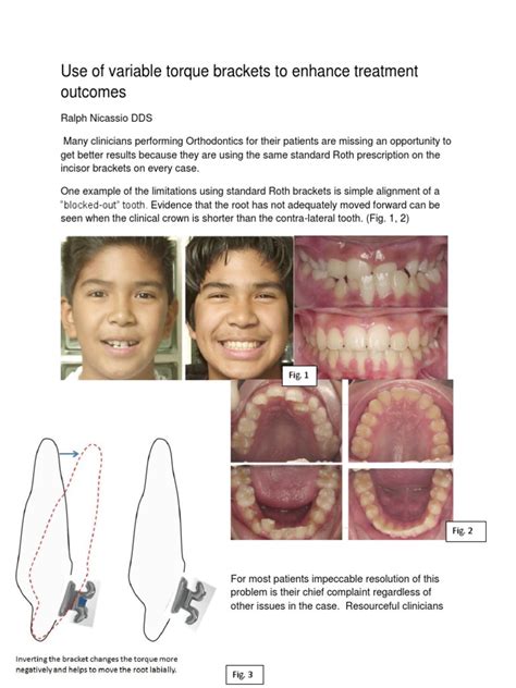 Variable Torque Brackets Pdf Orthodontics Mouth
