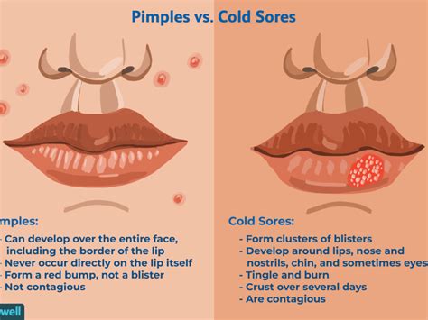 How To Tell The Difference Between Cold Sores And Chapped Lips