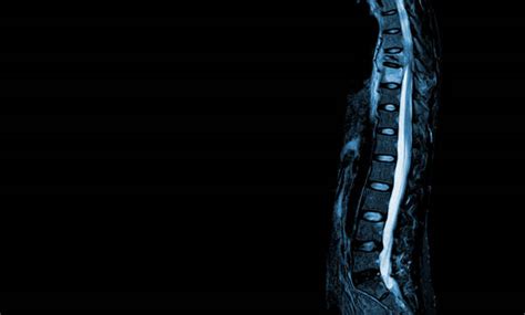 280개 이상의 Herniated Disc X Ray 스톡 사진 그림 및 Royalty Free 이미지 Istock