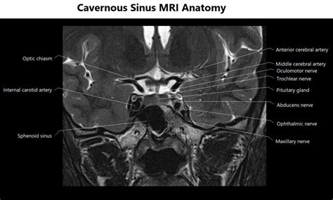 Cavernous Sinus The Endonasal Midline Inferior Intercavernous Approach
