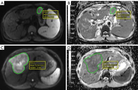 Simultaneous Multislice Echo Planar Diffusion Weighted Imaging Dwi In