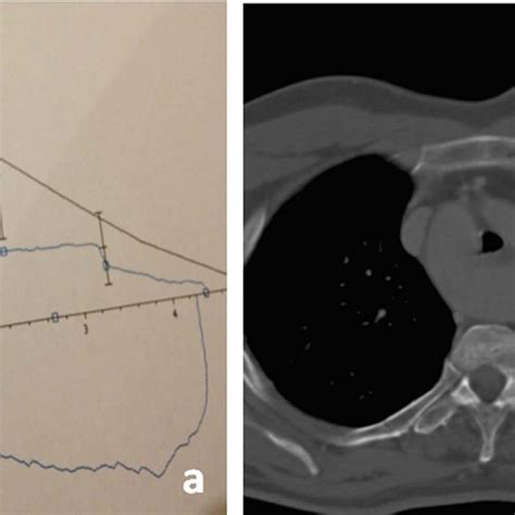 A Showing A Retrosternal Goitre Causing Tracheal Compression With 70 Download Scientific