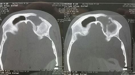 Frontal Bone Osteomyelitis