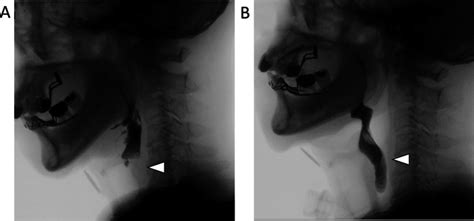 Swallowing Improvement Surgeries Pmc
