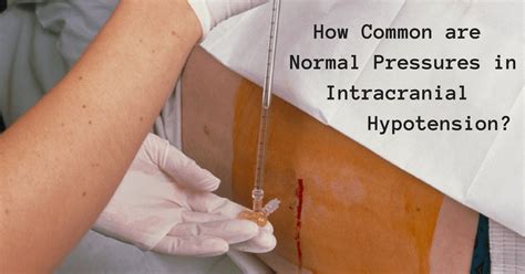 Normal Csf Pressures Common In Spontaneous Intracranial Hypotension
