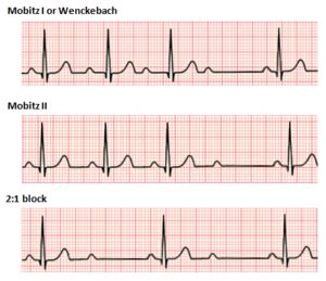 Second Degree Atrioventricular Block Wikipedia