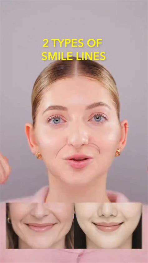 Most People Think Smile Lines Are Just Aging Not True There Are Two