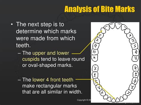 What Is Bite Mark Analysis At Chelsea Fick Blog