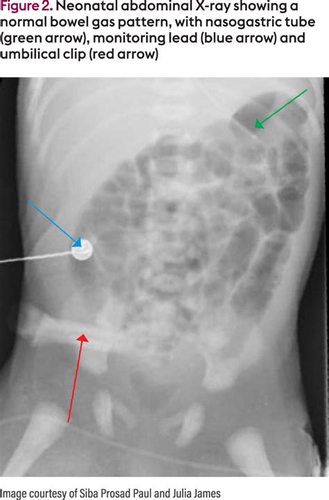 Abdominal X Ray Interpretation