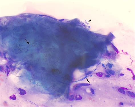 Candida Archives Eclinpath