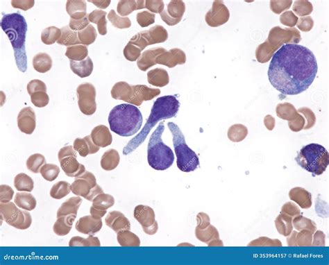 Blasts And Dendritic Cells In Acute Myeloid Leukemia Stock Image