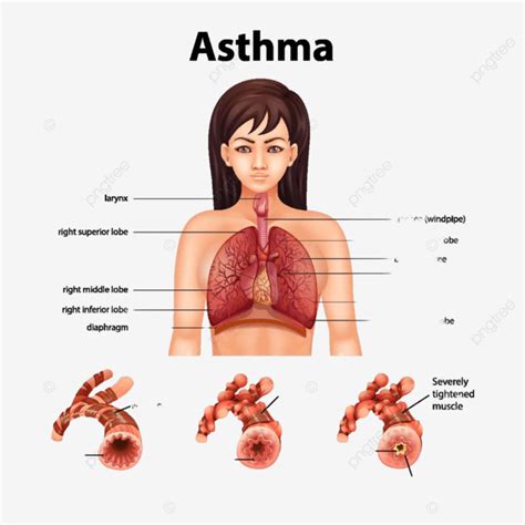 Comparison Of Healthy Lung And Asthmatic Lung Disease Science Information Vector Disease