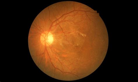 Hyperviscosity Retinopathy