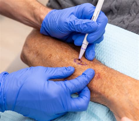Skin Lesions Treatment