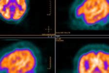 Neuroimaging North Dakota Brain Injury Network