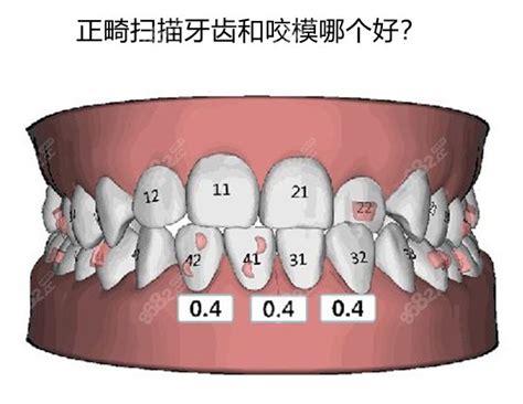 正畸扫描牙齿和咬模哪个好？可看口扫和普通取模的优缺点下颌前突 8682整形网