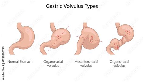 Gastric Volvulus Types Normal Stomach Organo Axial Volvulus Mesentero Axial Volvulus With